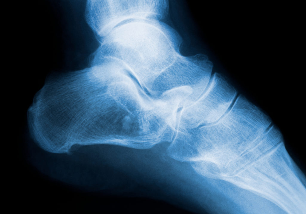 Diabetes & Arthritis | Podiatrist North Shore